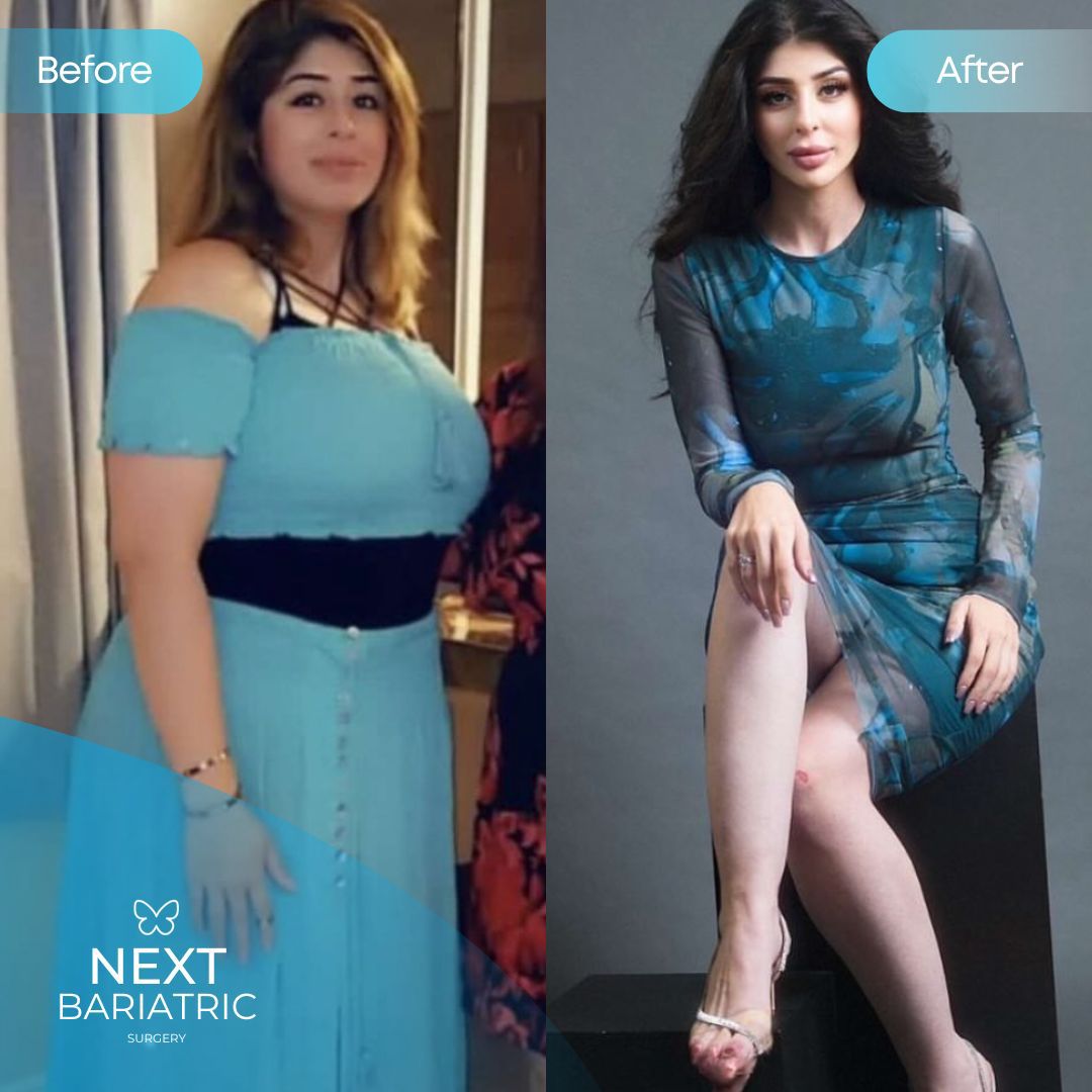 Before And After Bariatric Surgery Next Body Surgery